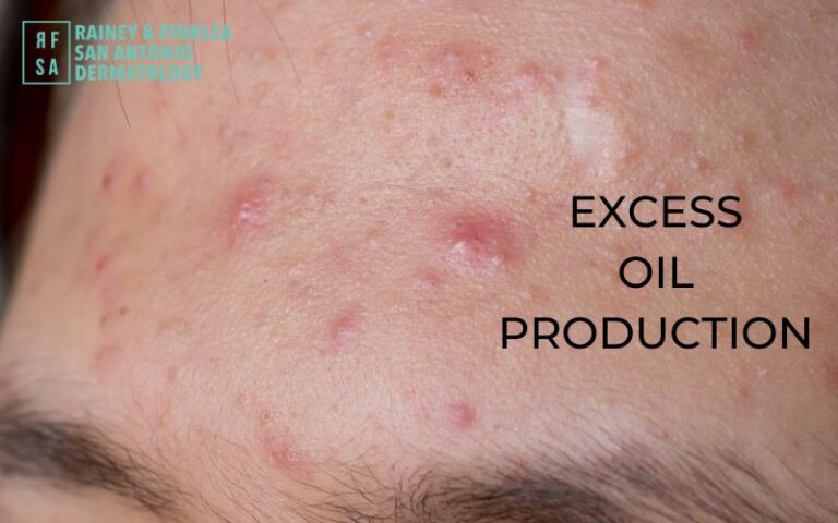 The #1 Acne Treatment In San Antonio | RFSA Dermatology