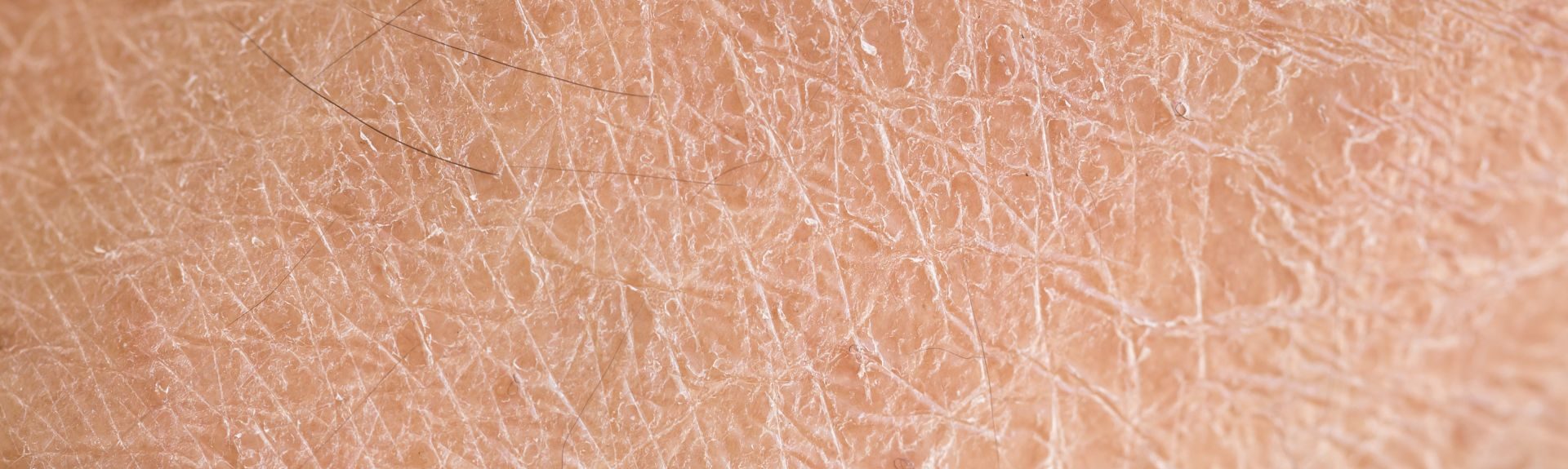 Say Goodbye To Dry Skin: Tips And Treatments